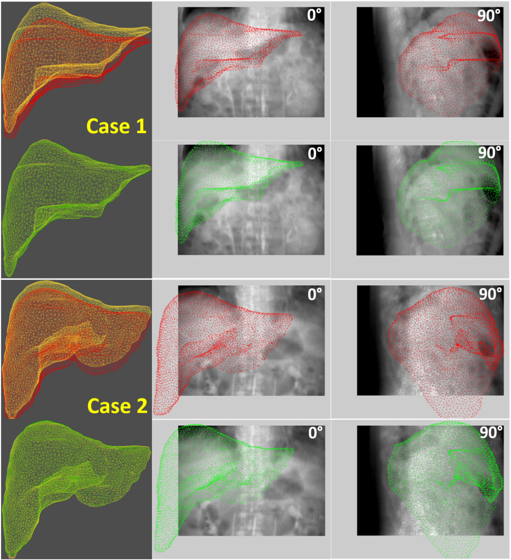 Real-time liver tumor localization via combined surface imaging and a ...