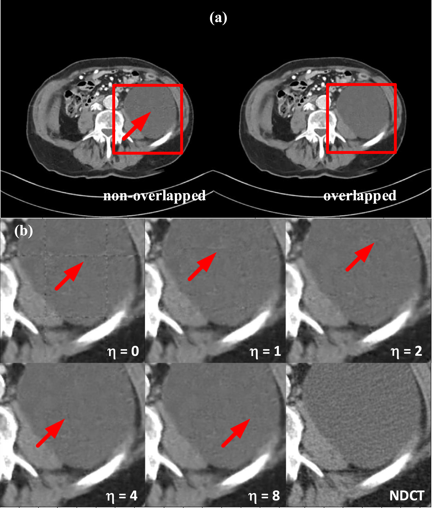 CTformer: convolution-free Token2Token dilated vision transformer for low-dose CT denoising ...