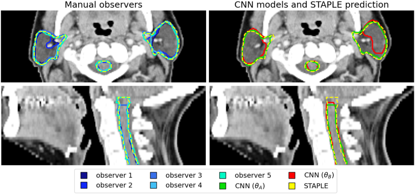 Accurate segmentation of head and neck radiotherapy CT scans with 3D ...