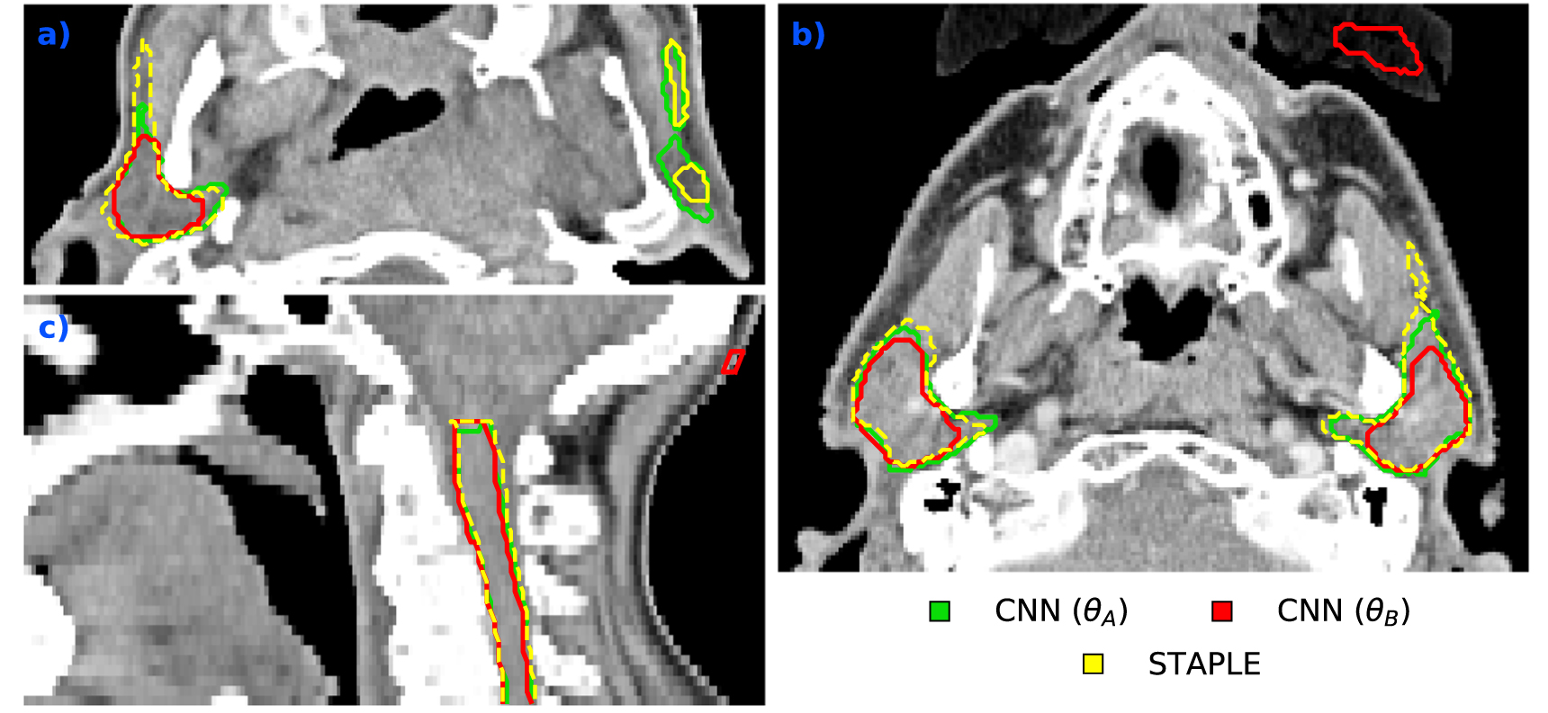 Accurate segmentation of head and neck radiotherapy CT scans with 3D ...