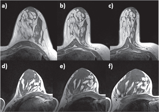 Towards a biomechanical breast model to simulate and investigate breast ...