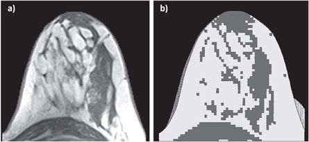 Towards a biomechanical breast model to simulate and investigate breast ...