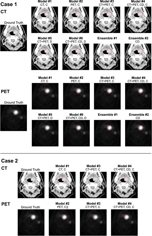 Head and neck tumor segmentation convolutional neural network robust to missing PET/CT ...