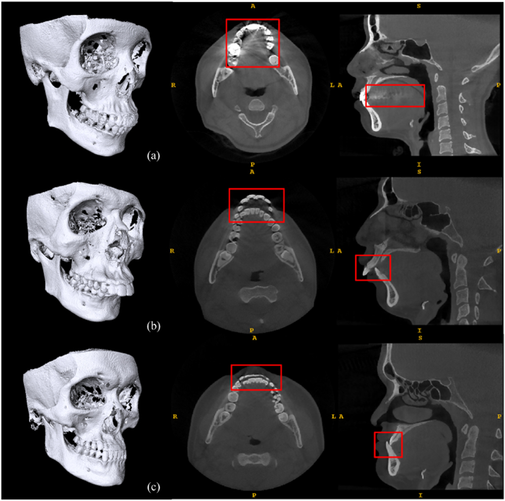CMF-Net: craniomaxillofacial landmark localization on CBCT images using ...