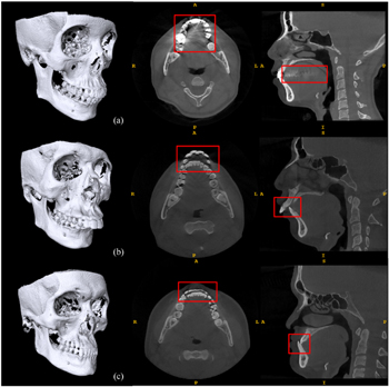 CMF-Net: craniomaxillofacial landmark localization on CBCT images using ...