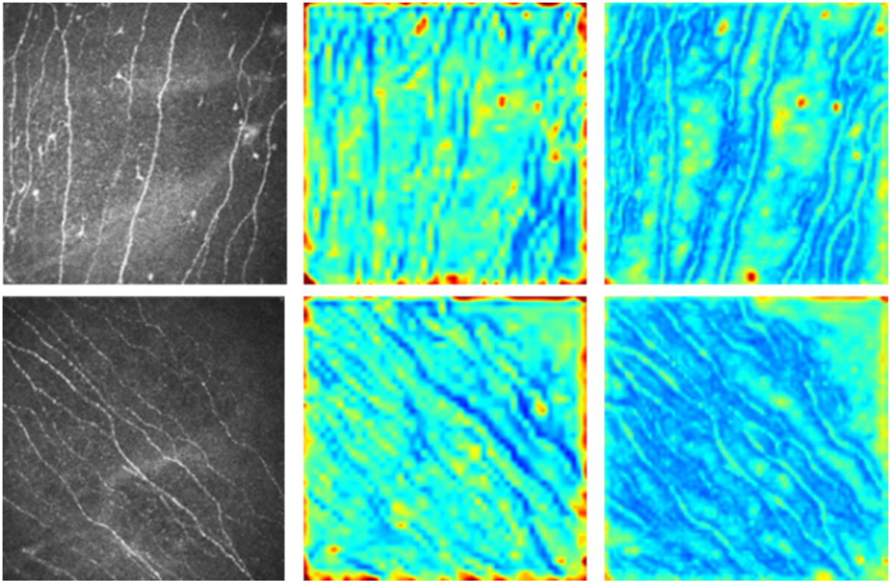 Multi-scale and local feature guidance network for corneal nerve fiber ...