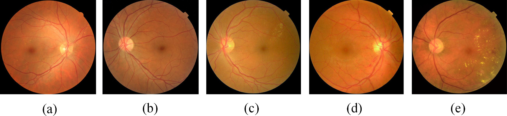 Multi-scale multi-attention network for diabetic retinopathy grading ...