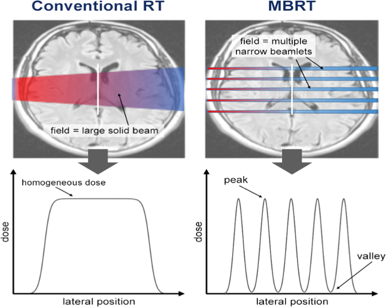 Spatially fractionated radiation therapy: a critical review on current ...