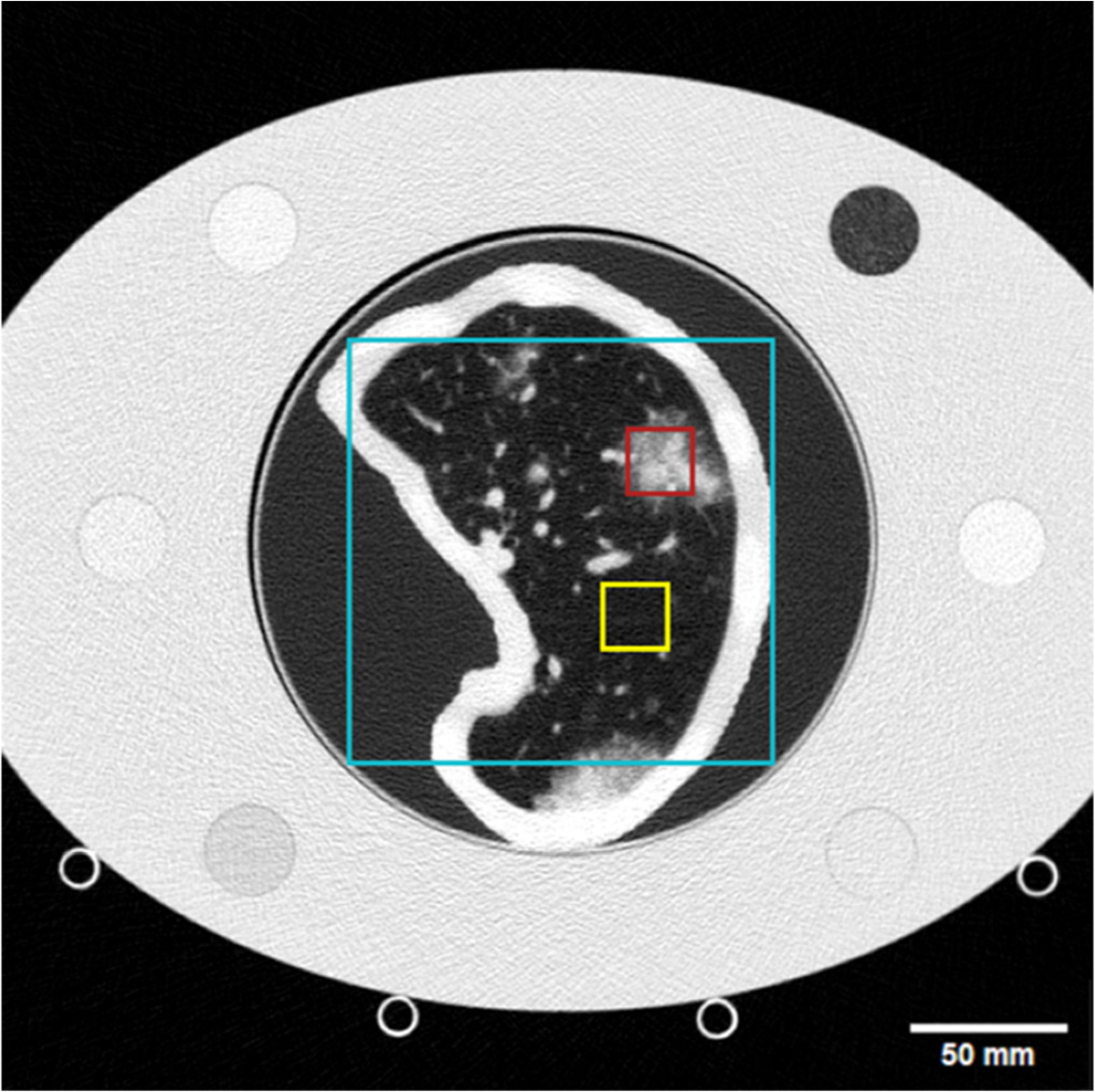 Patient-derived PixelPrint phantoms for evaluating clinical imaging ...