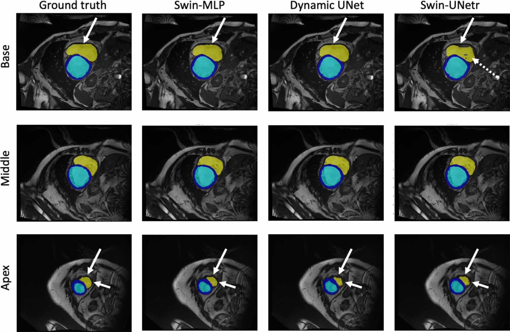 Cardiac MRI segmentation using shifted-window multilayer perceptron mixer networks - IOPscience