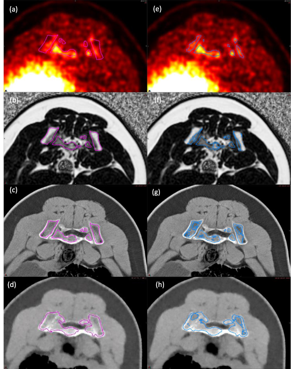 Feasibility of identifying proliferative active bone marrow with fat ...