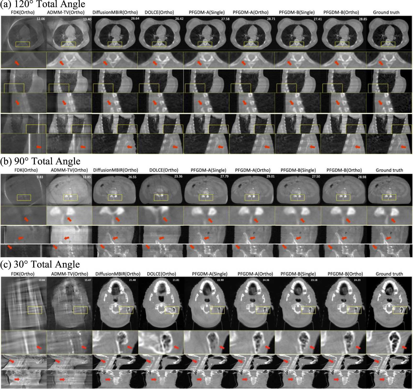 Prior frequency guided diffusion model for limited angle (LA)-CBCT ...