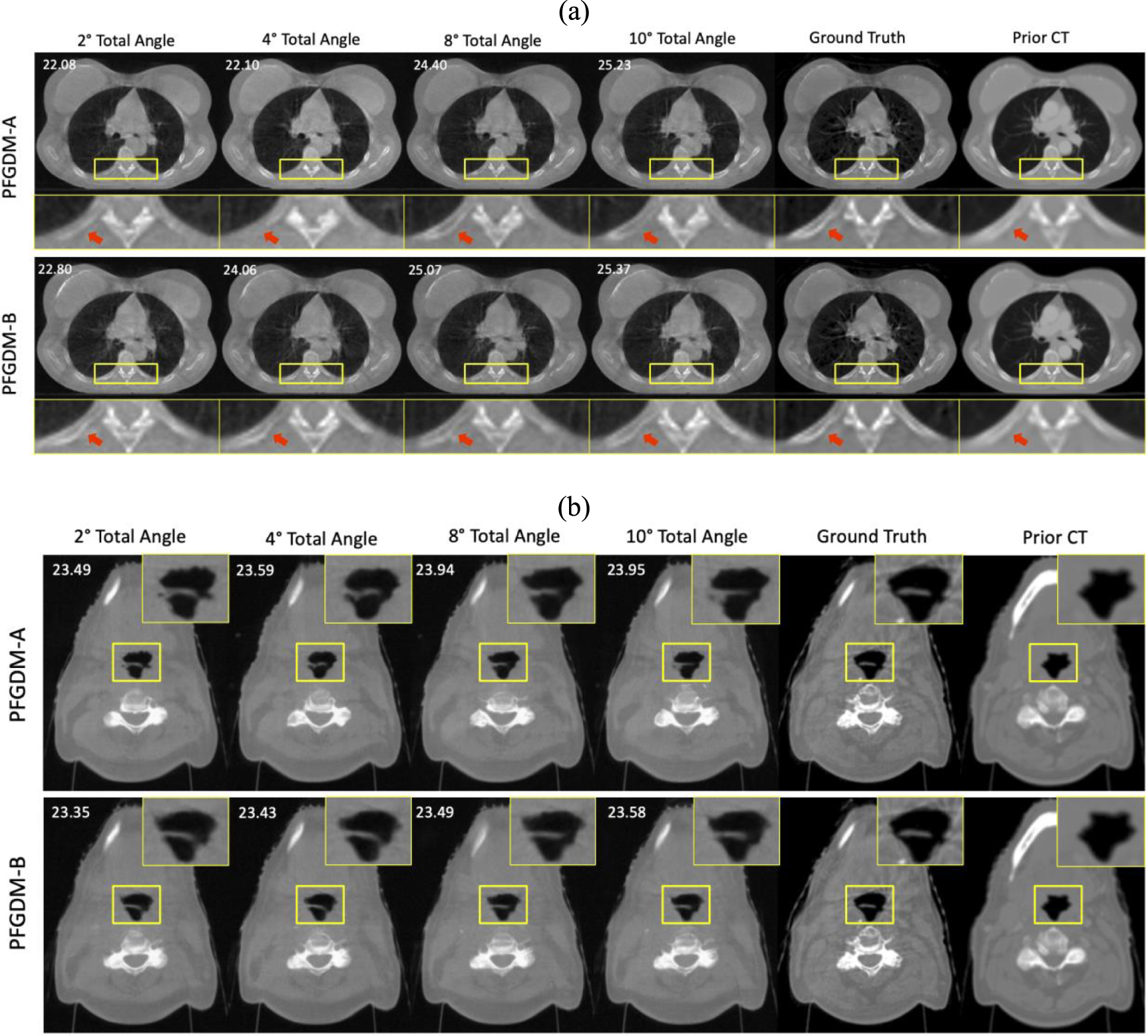 Prior frequency guided diffusion model for limited angle (LA)-CBCT ...