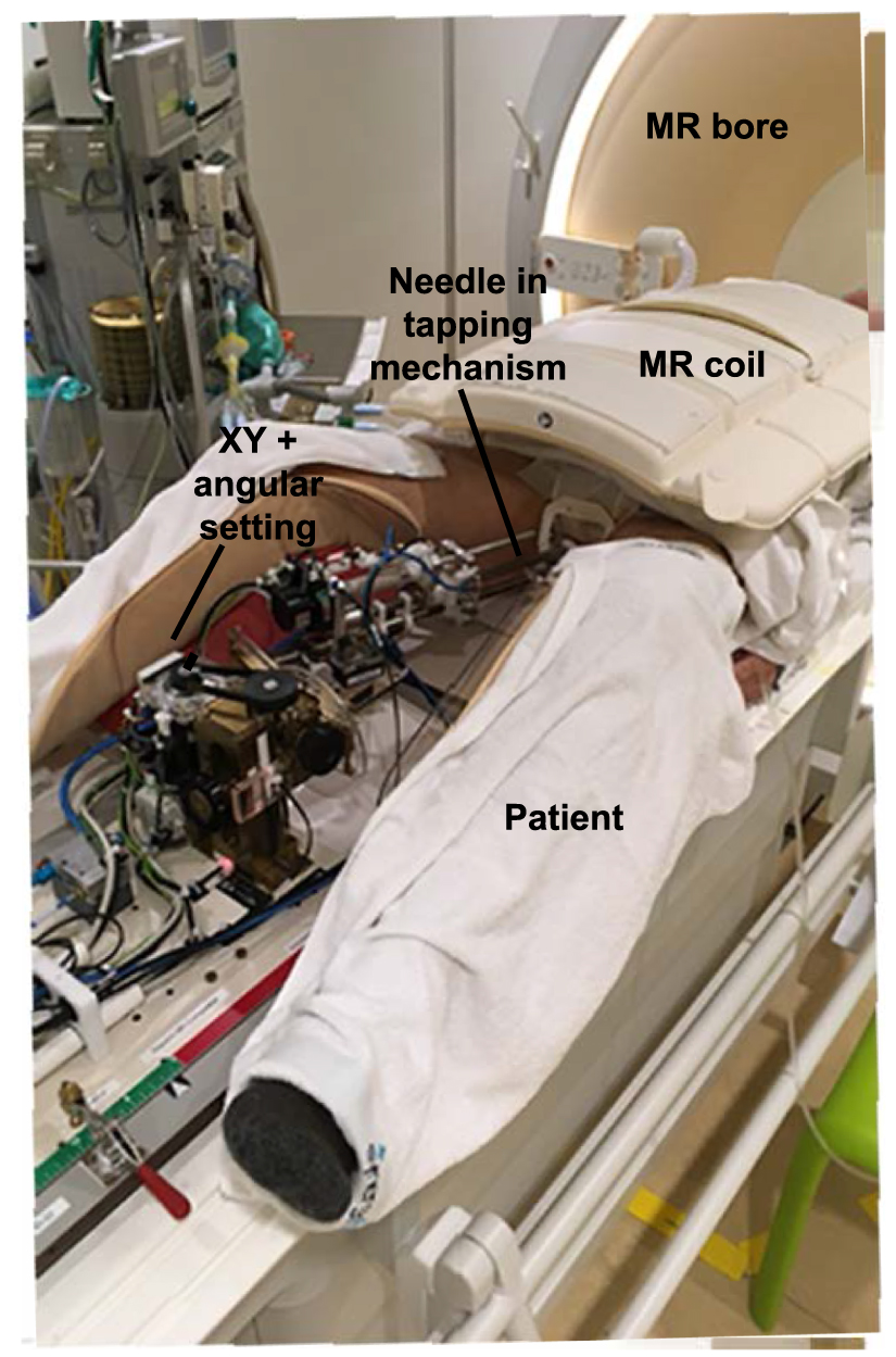 Robotic MR-guided high dose rate brachytherapy needle implantation in ...