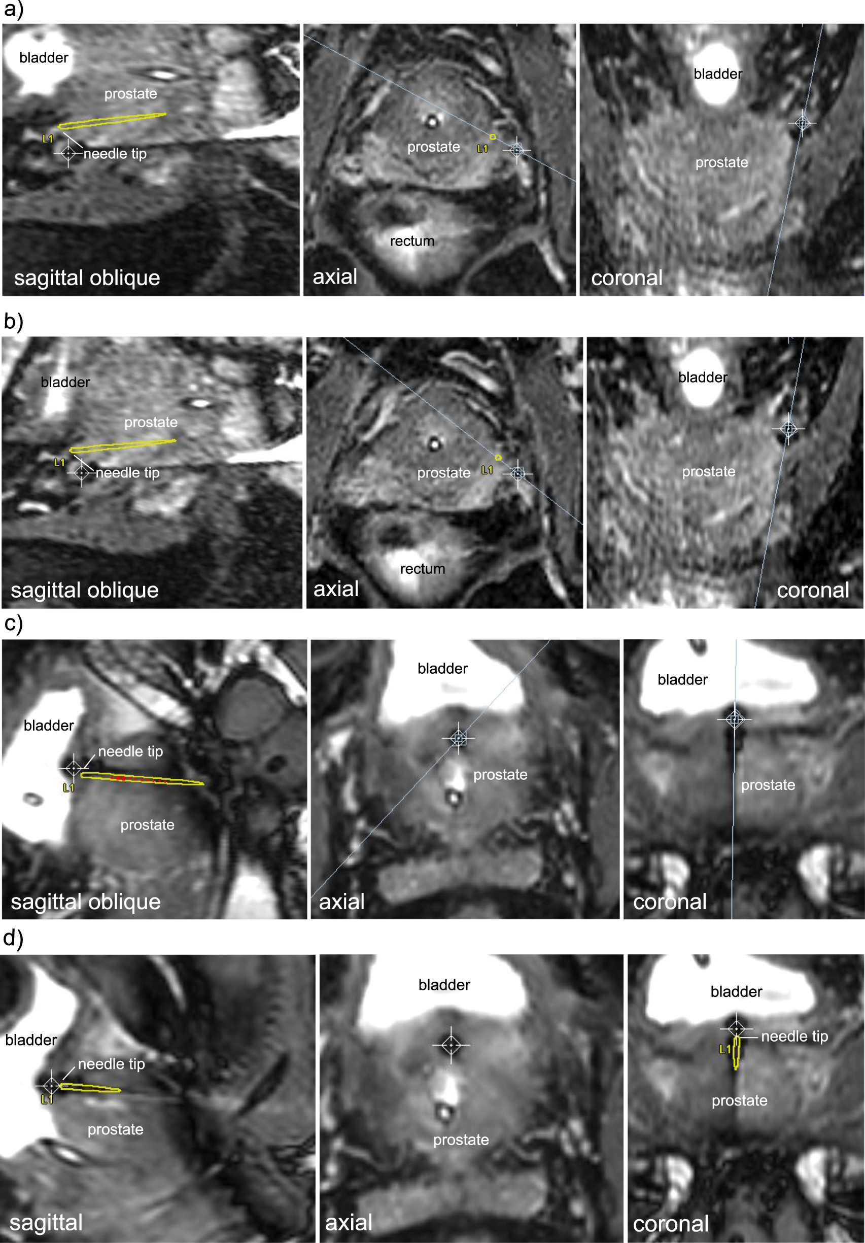 Robotic MR-guided high dose rate brachytherapy needle implantation in ...
