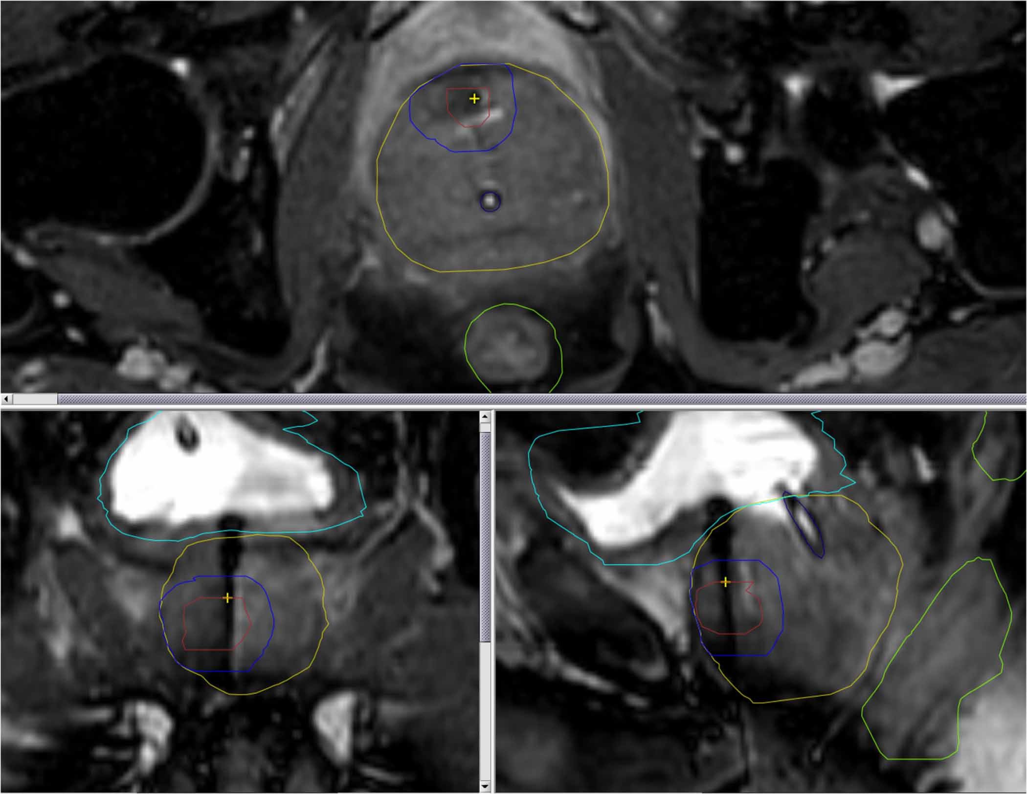 Robotic MR-guided high dose rate brachytherapy needle implantation in ...