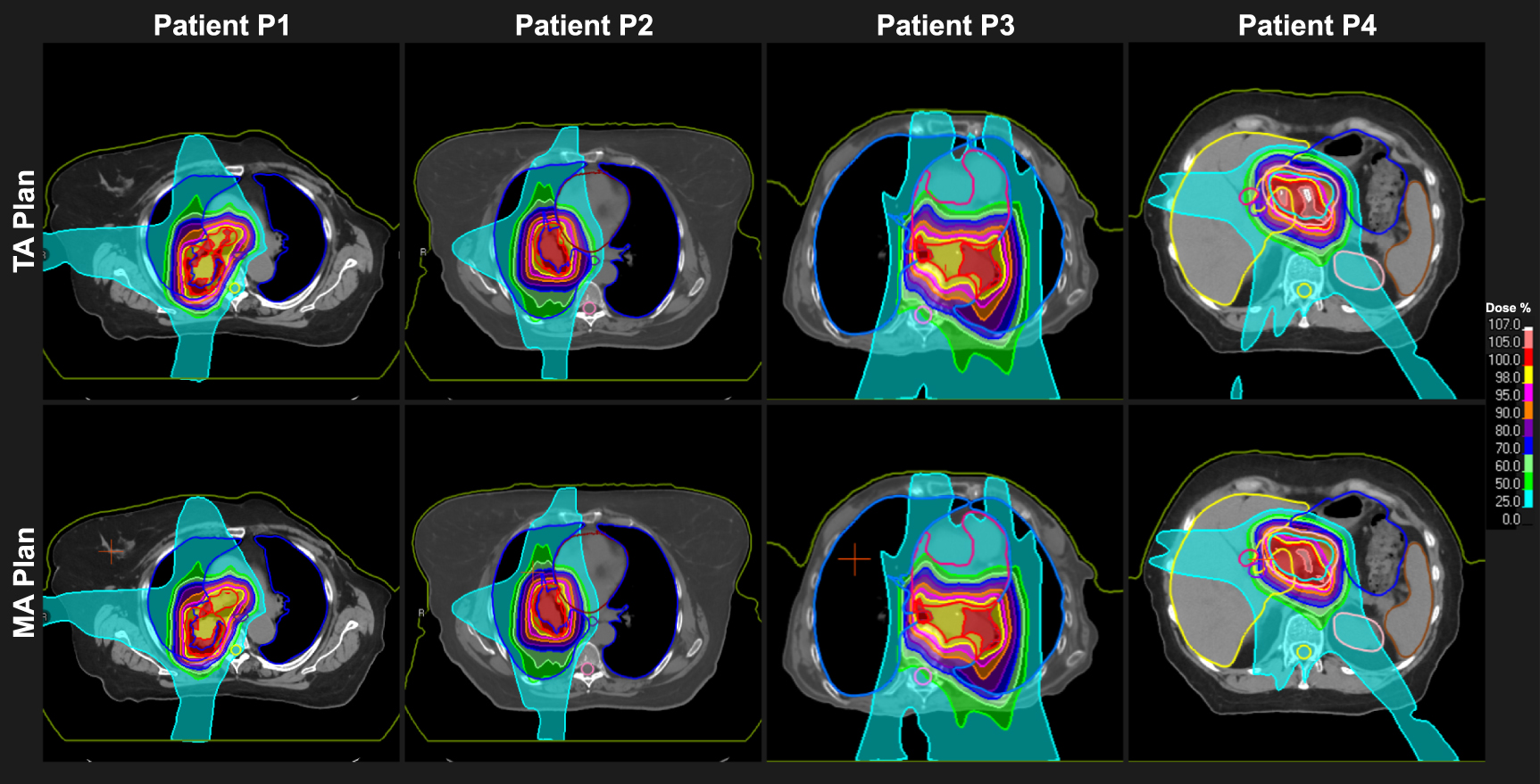 Adaptive intensity modulated proton therapy using 4D robust planning: a ...