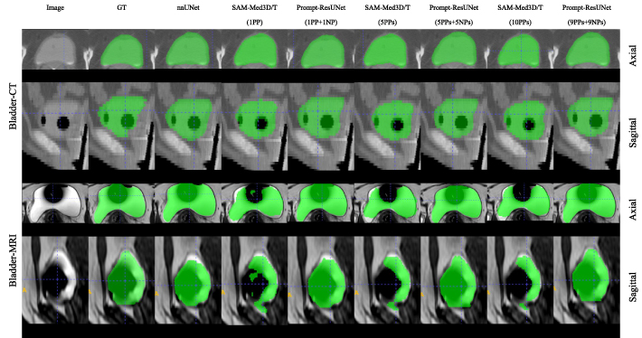 Deep learning-based segmentation for high-dose-rate brachytherapy in cervical cancer using 3D ...