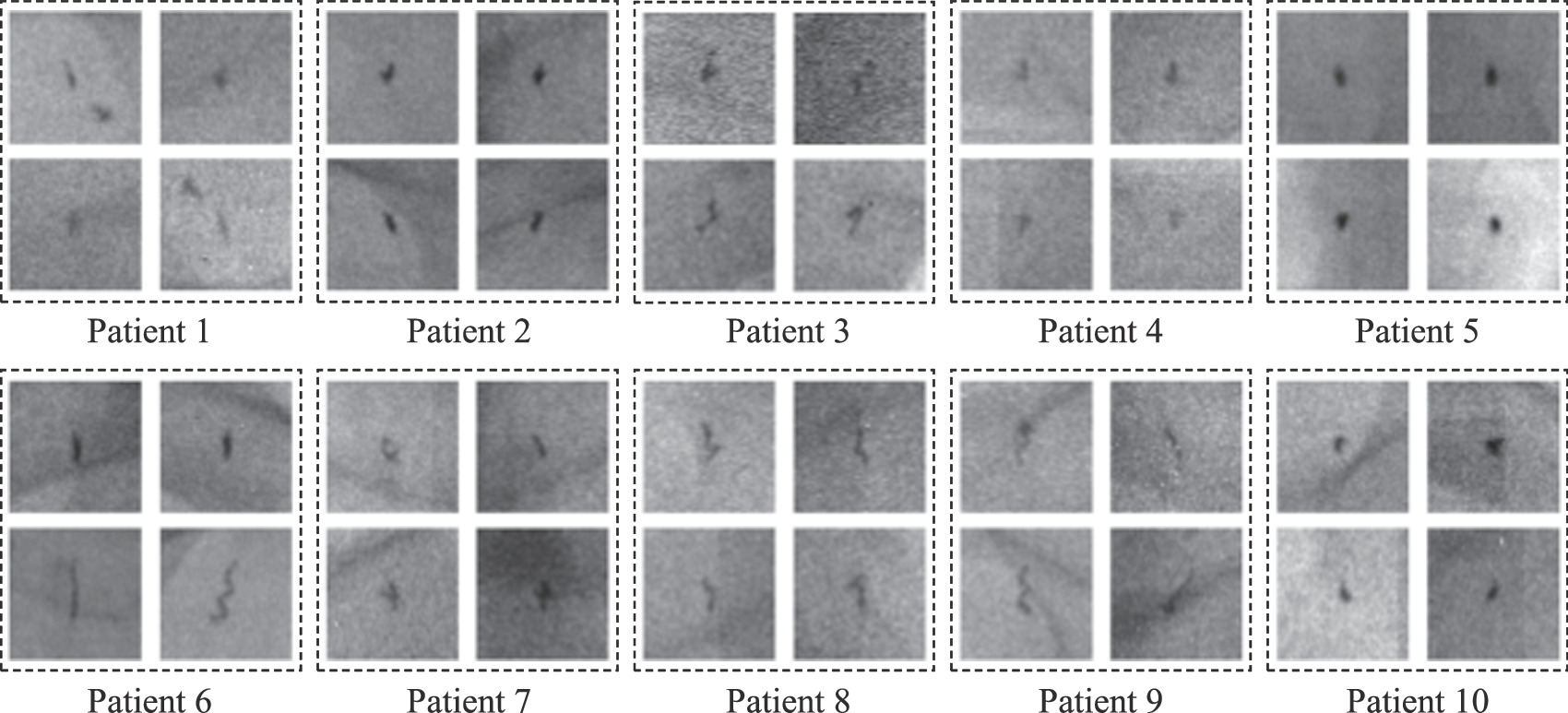 Real-time nonstandard-shaped gold fiducial marker tracking on x-ray ...