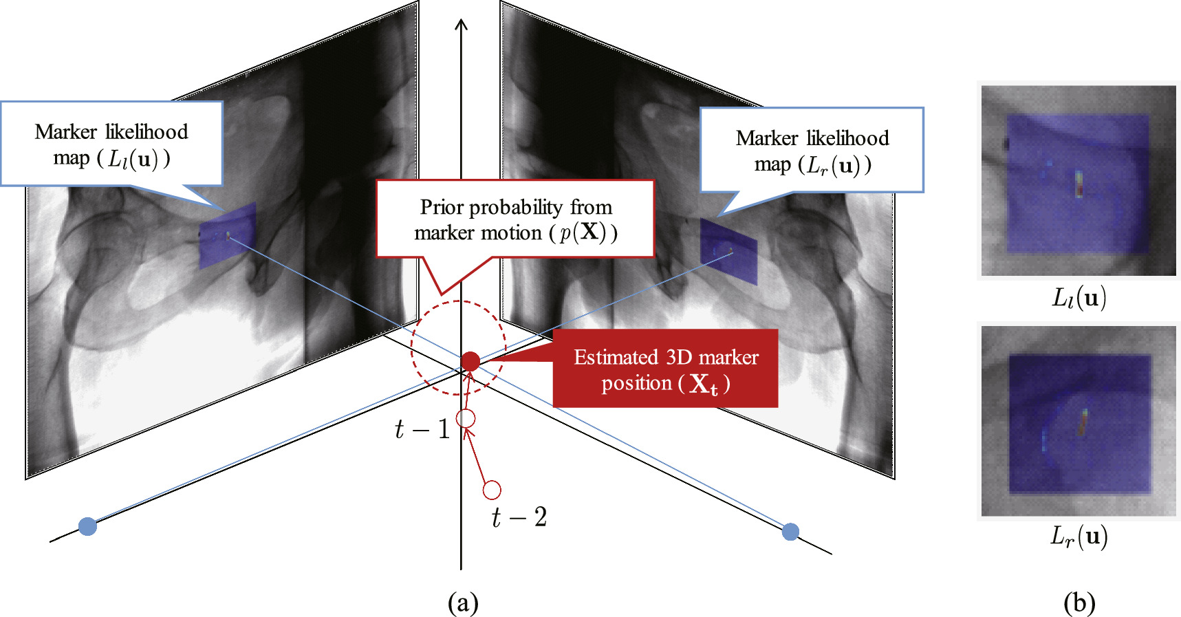 Real-time nonstandard-shaped gold fiducial marker tracking on x-ray fluoroscopic images for ...