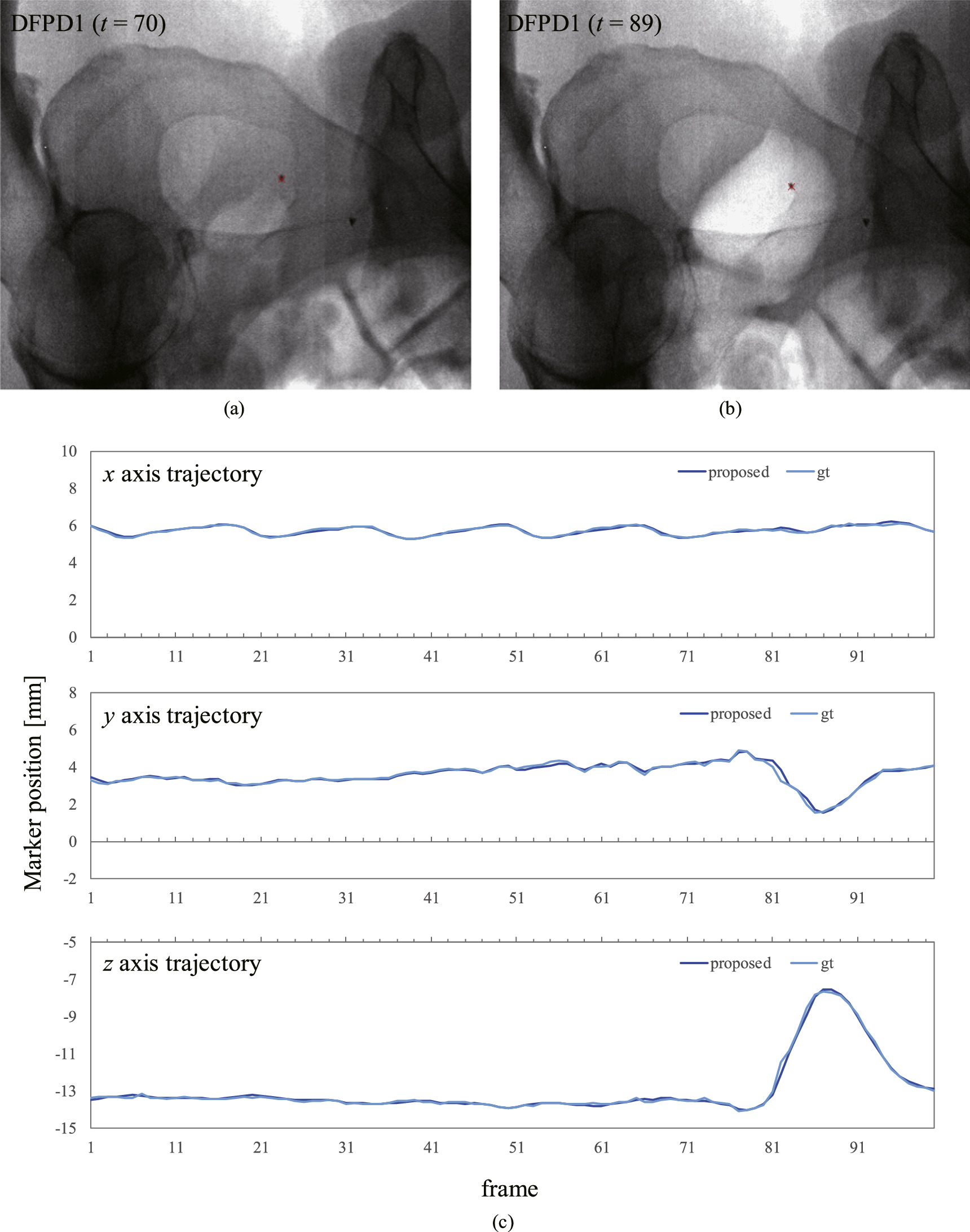 Real-time nonstandard-shaped gold fiducial marker tracking on x-ray ...