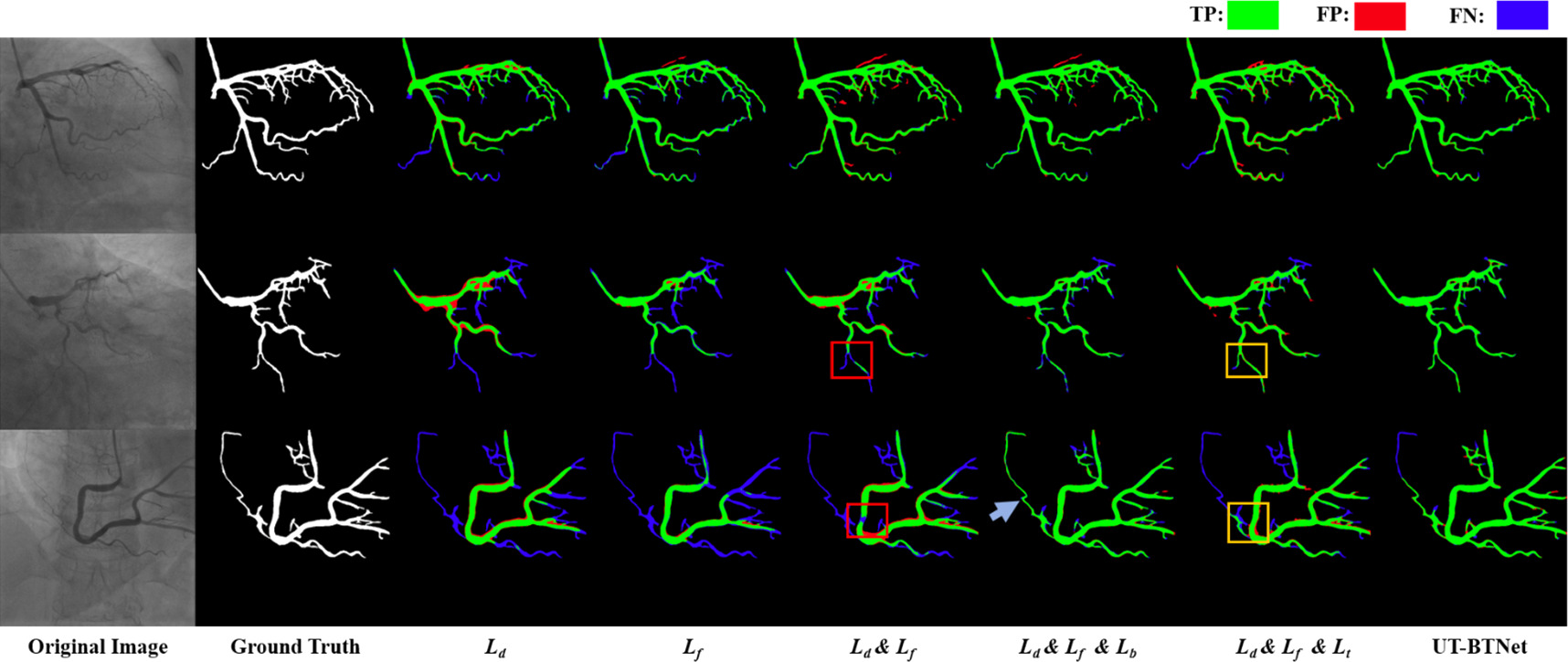 Coronary vessel segmentation in coronary angiography with a multi-scale ...