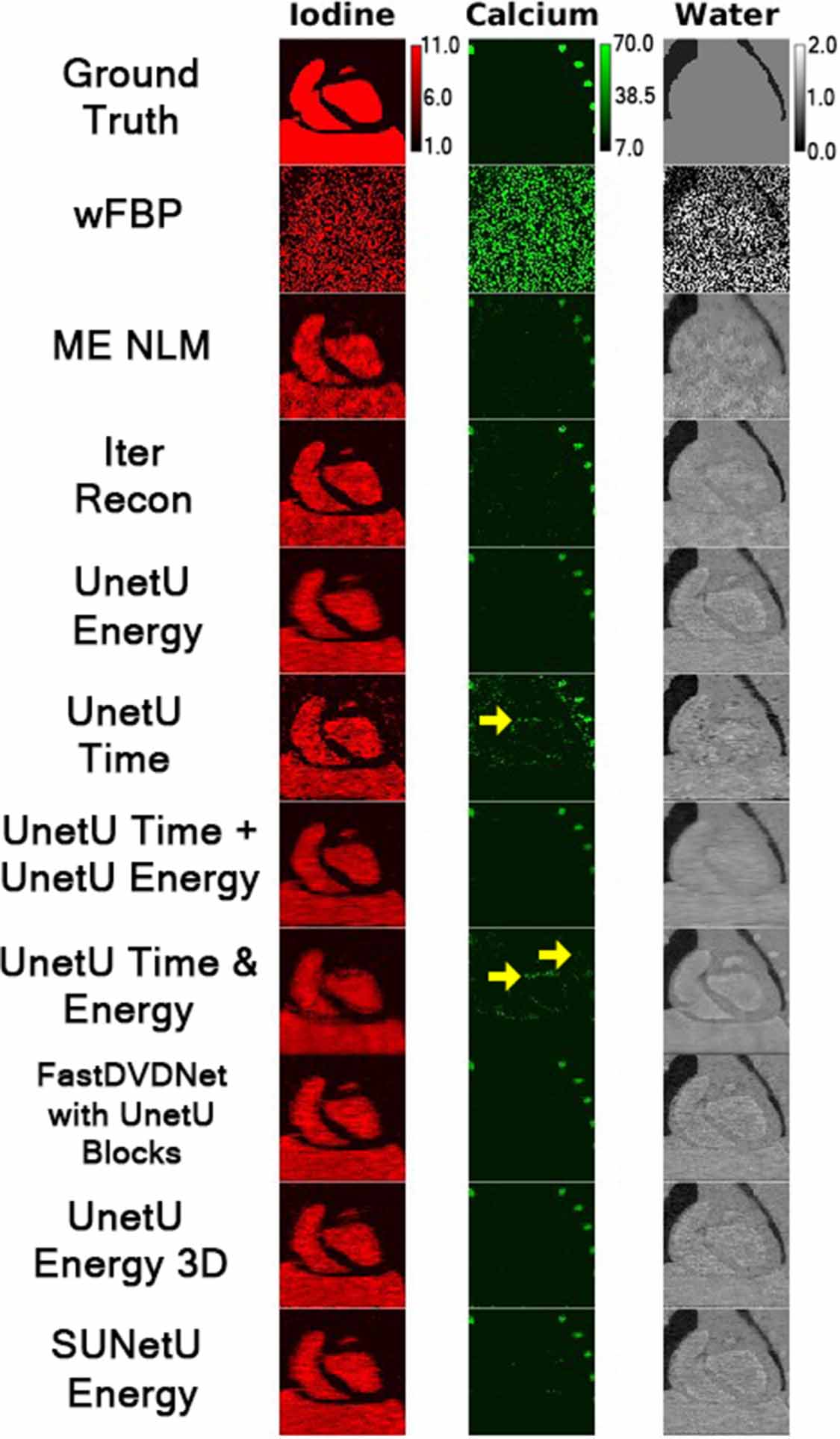 Investigating deep learning strategies for fast denoising of 5D cardiac ...