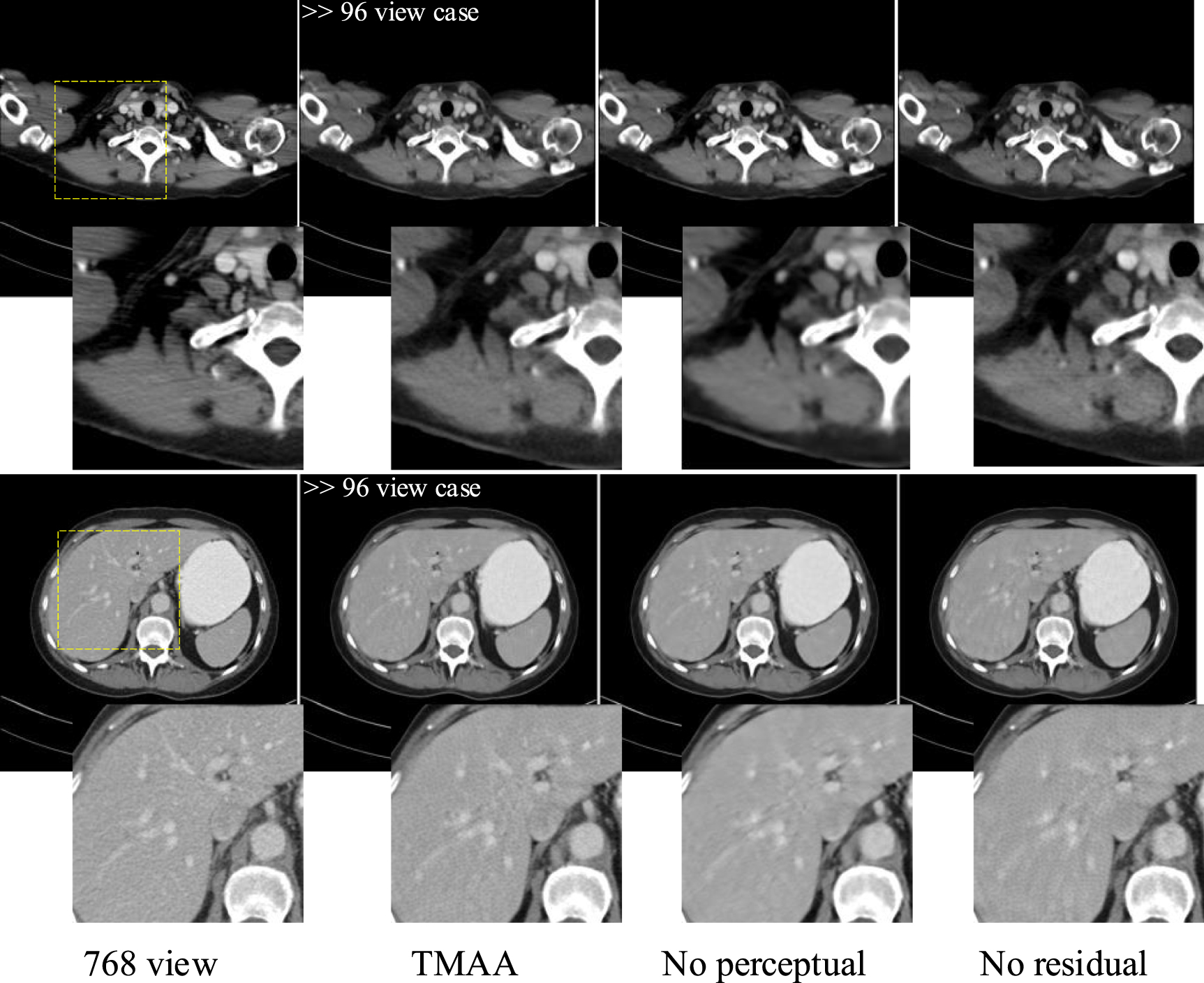 TMAA-net: tensor-domain multi-planal anti-aliasing network for sparse ...