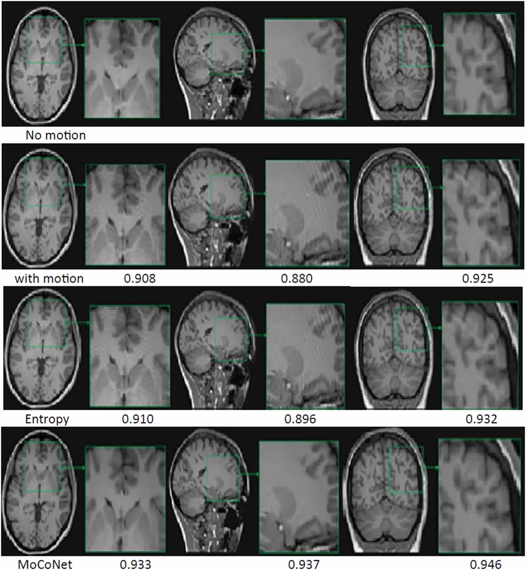 Deep learning methods for 3D magnetic resonance image denoising, bias ...