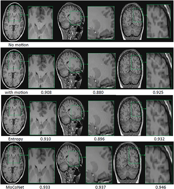 Deep learning methods for 3D magnetic resonance image denoising, bias ...