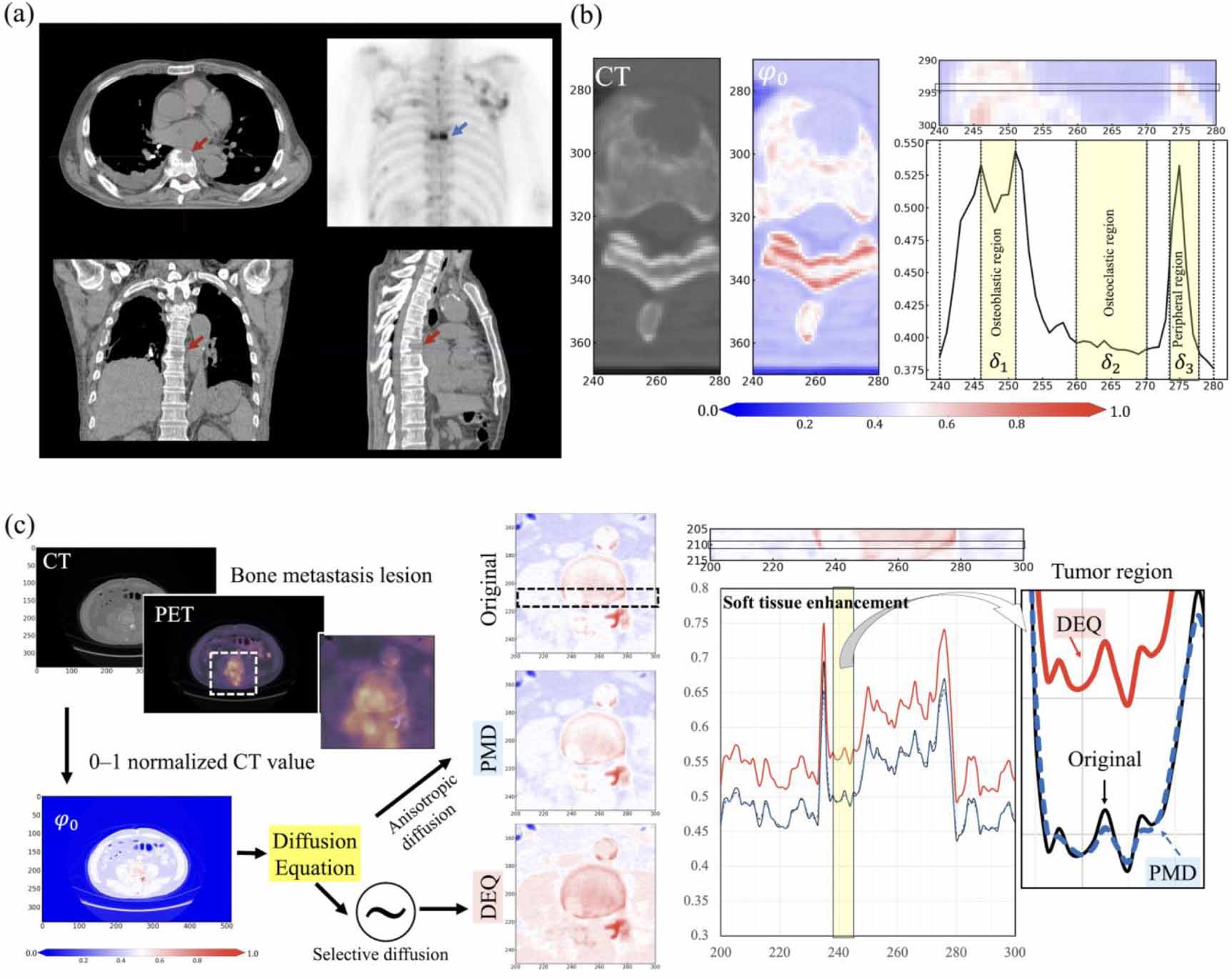 Diffusion equation quantification: selective enhancement algorithm for bone metastasis lesions ...