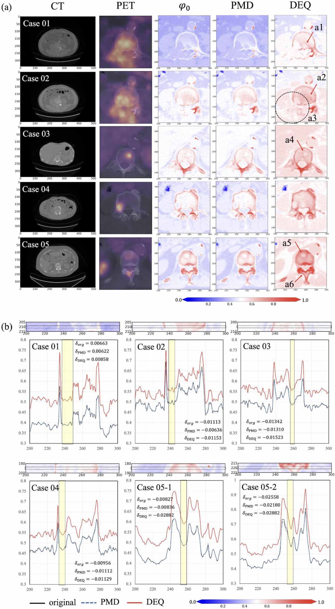 Diffusion equation quantification: selective enhancement algorithm for bone metastasis lesions ...