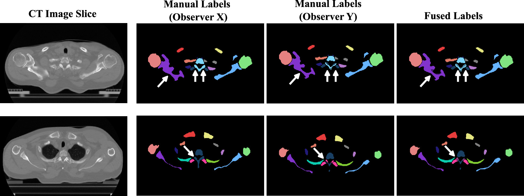 Essential parameters needed for a U-Net-based segmentation of individual bones on planning CT ...