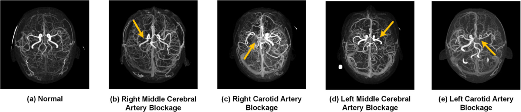 LVONet: automatic classification model for large vessel occlusion based ...