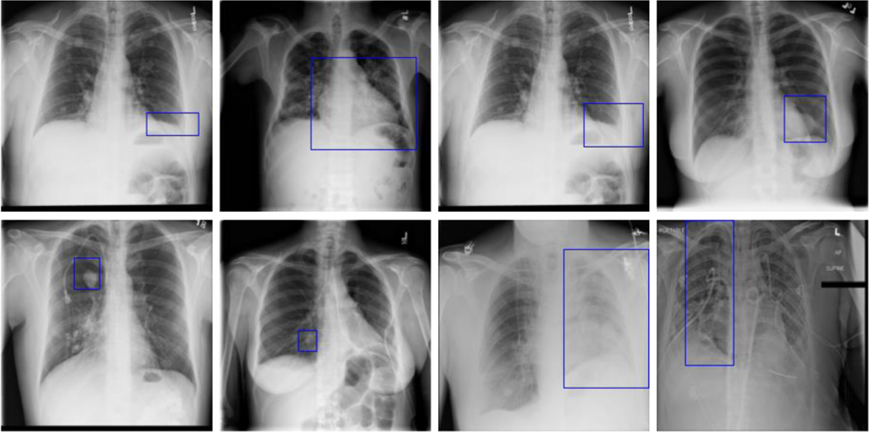 Chest x-ray diagnosis via spatial-channel high-order attention ...