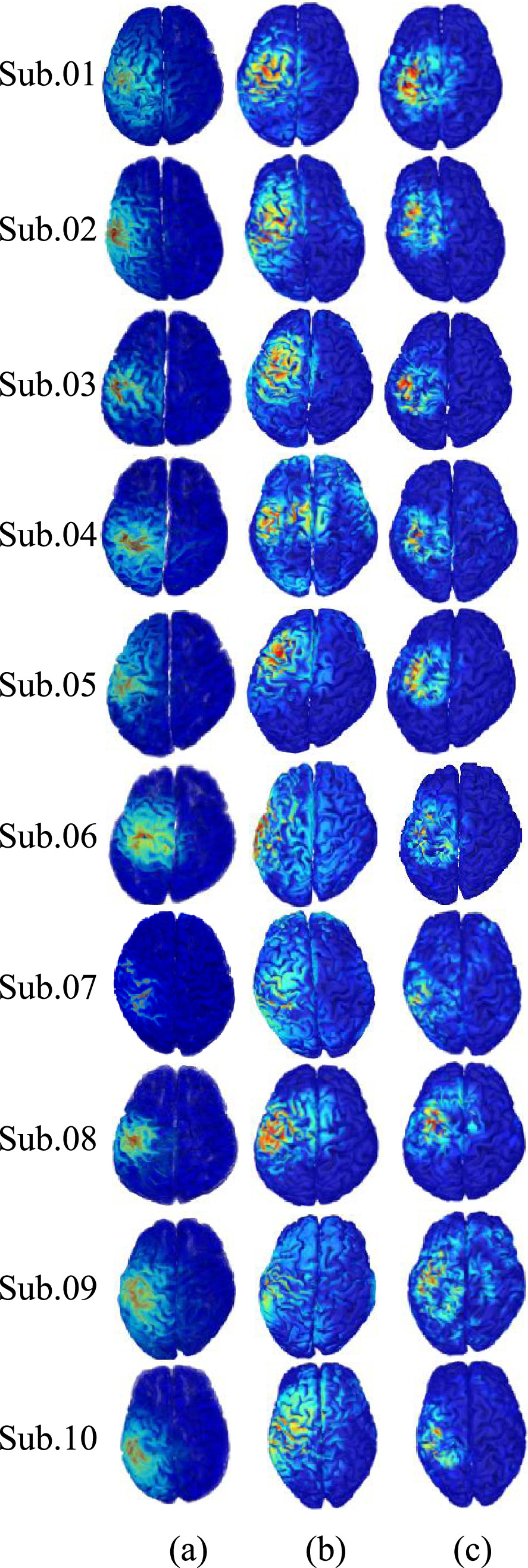 High-resolution EEG source localization in personalized segmentation ...