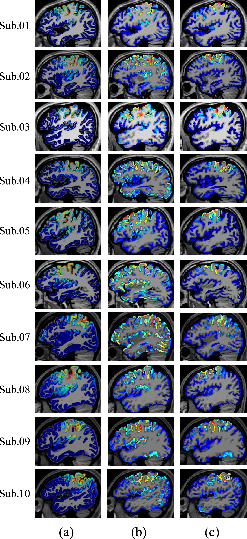 High-resolution EEG source localization in personalized segmentation ...