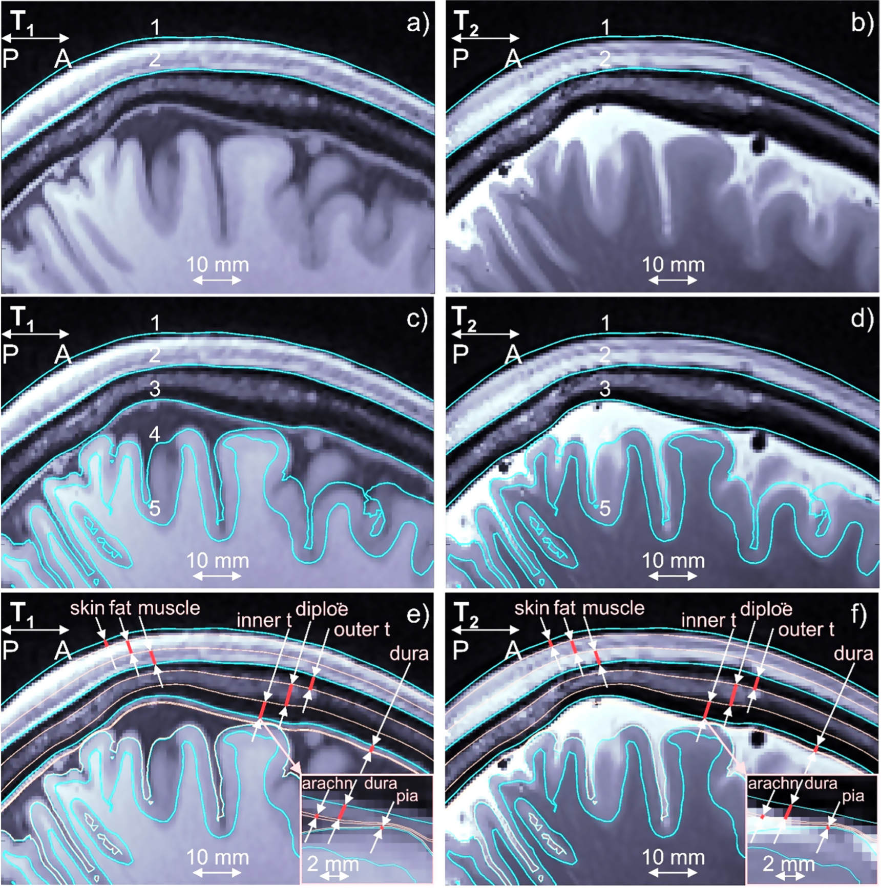 An adaptive h-refinement method for the boundary element fast multipole ...