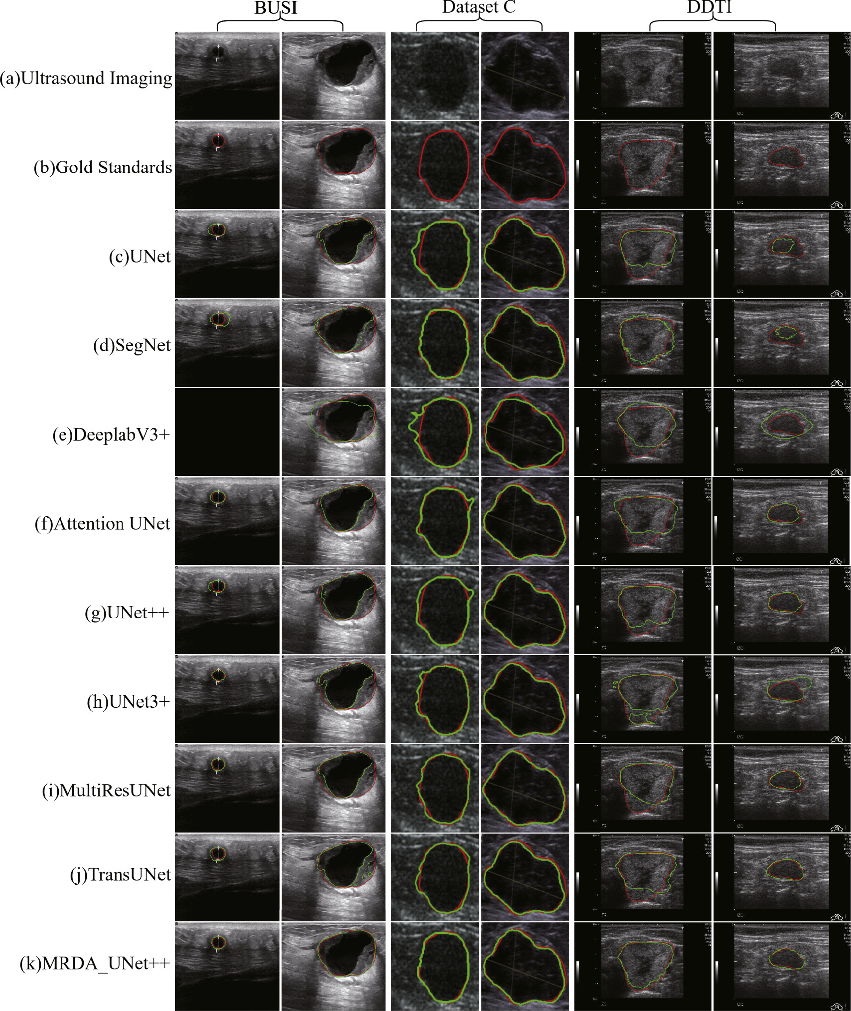 Ultrasound image segmentation of renal tumors based on UNet++ with ...