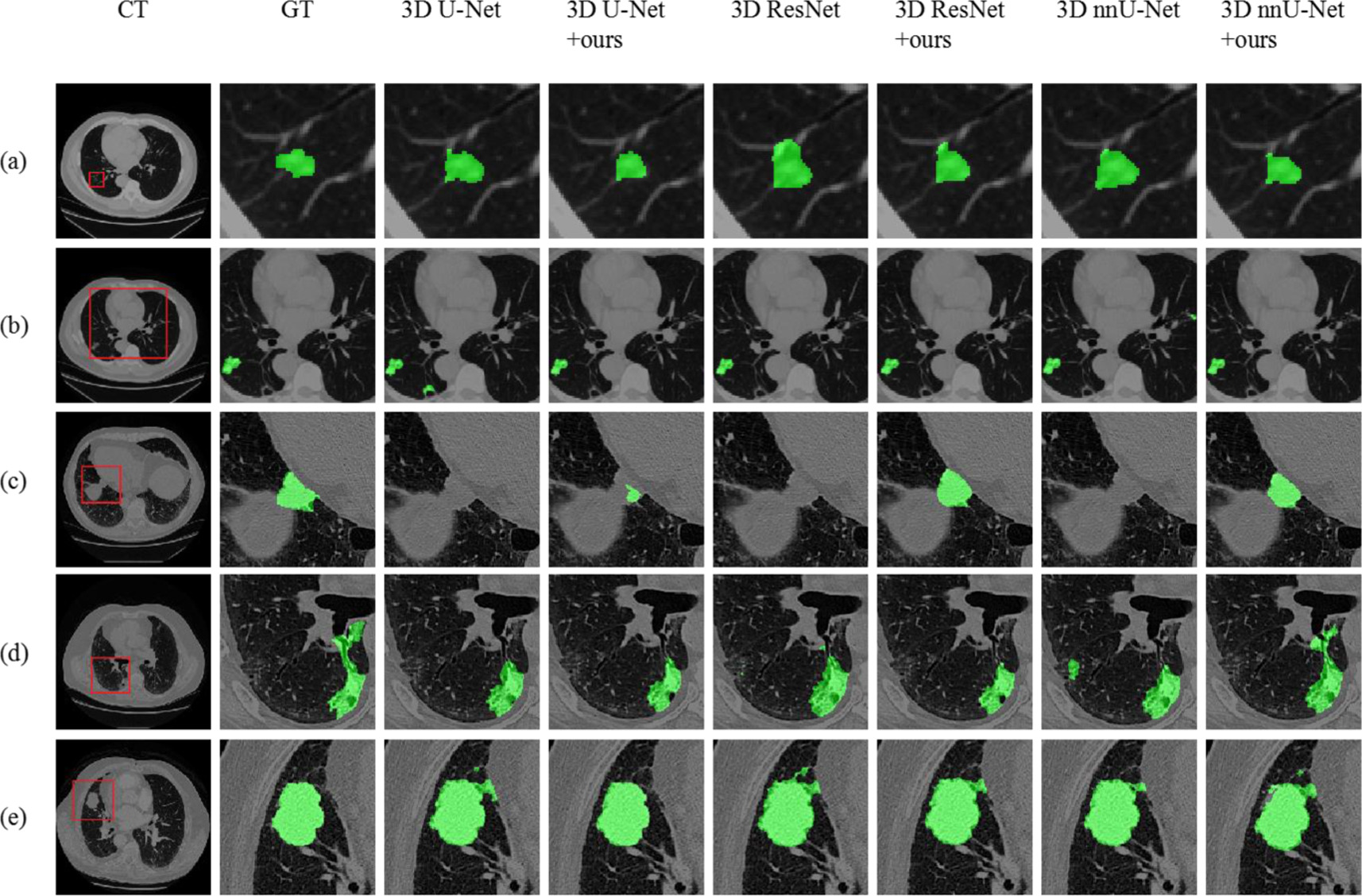 Mutually enhanced multi-view information learning for segmentation of lung tumor in CT images ...