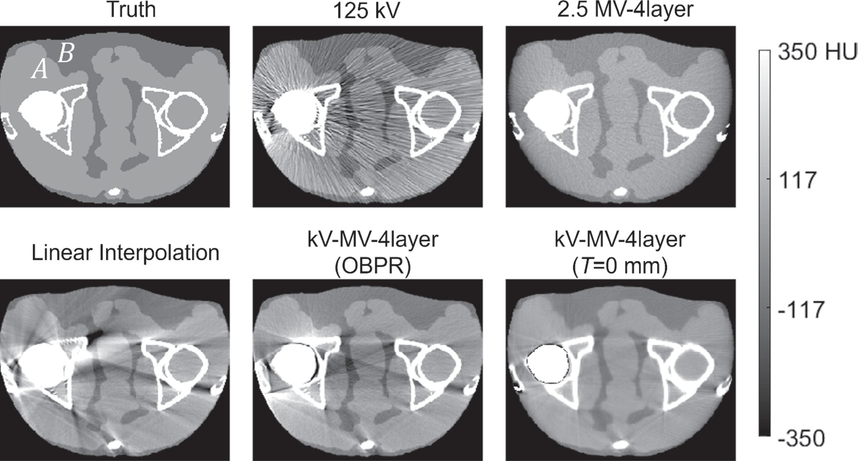 A kV–MV approach to CBCT metal artifact reduction using multi-layer MV ...