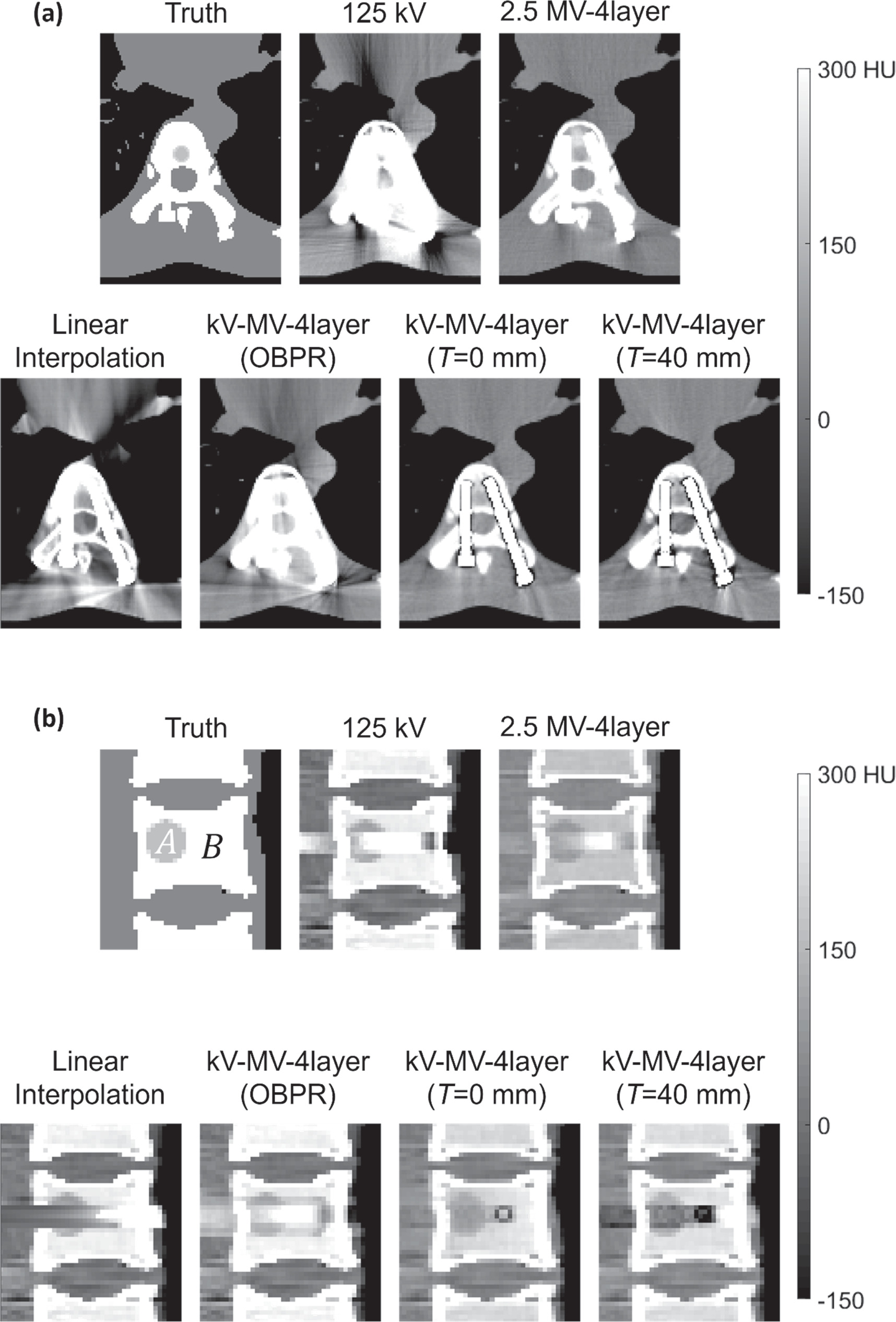 A kV–MV approach to CBCT metal artifact reduction using multi-layer MV ...