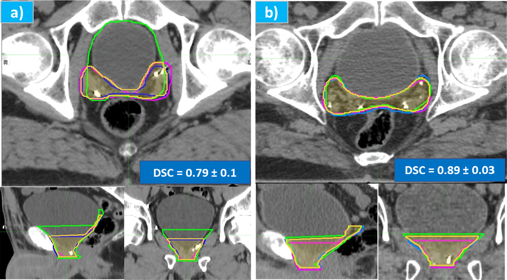 Evaluating the relationship between contouring variability and modelled ...