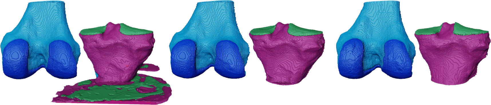 Joint reconstruction and segmentation in undersampled 3D knee MRI ...