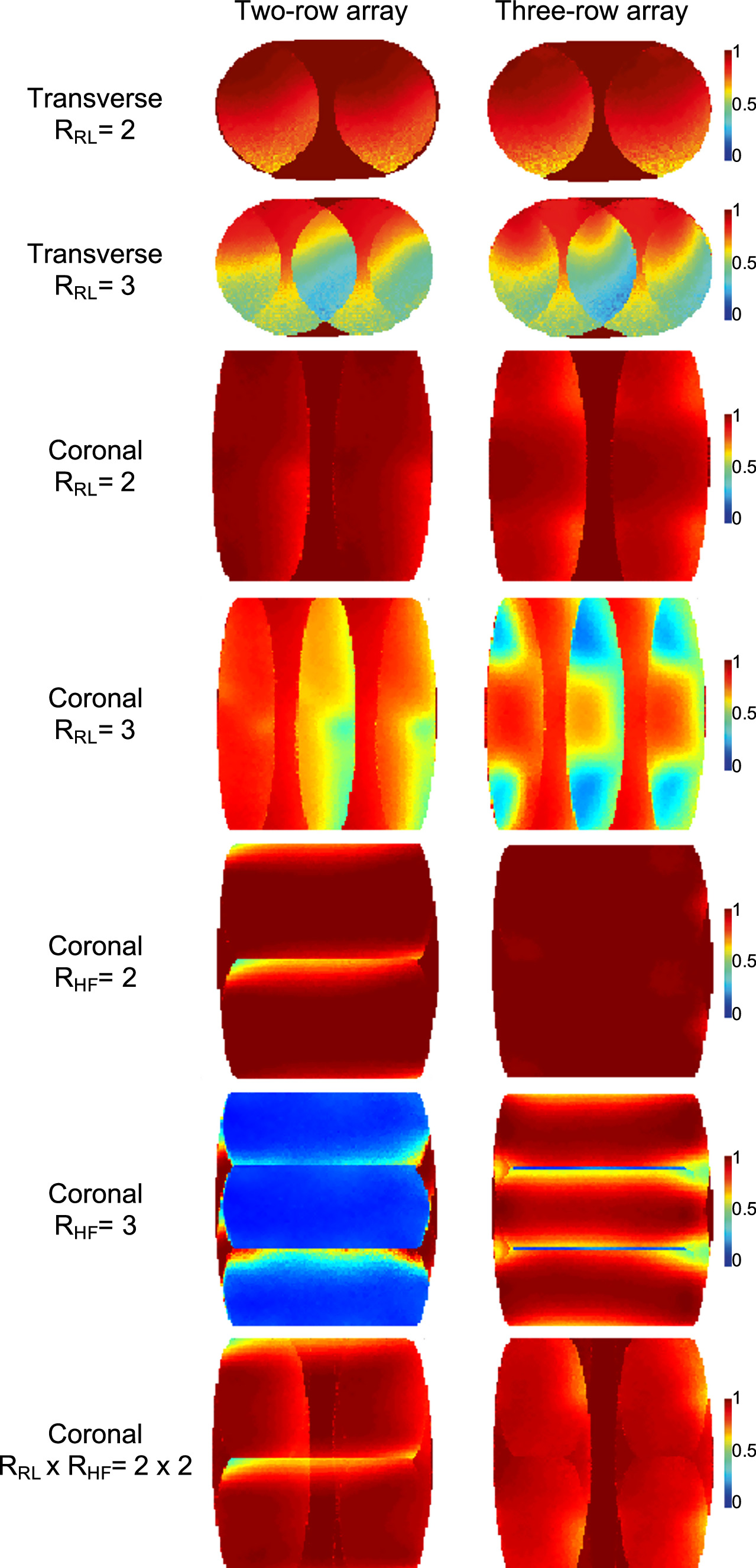 Three-row MRI receive array with remote circuitry to preserve radiation ...