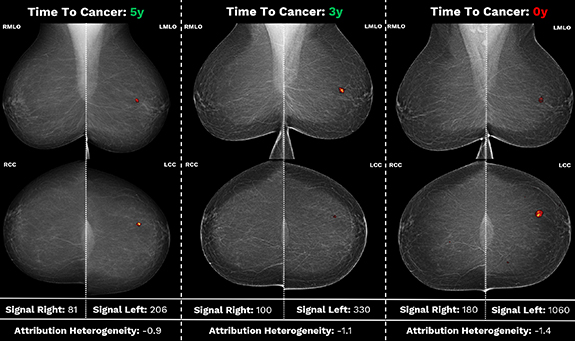 Longitudinal interpretability of deep learning based breast cancer risk ...
