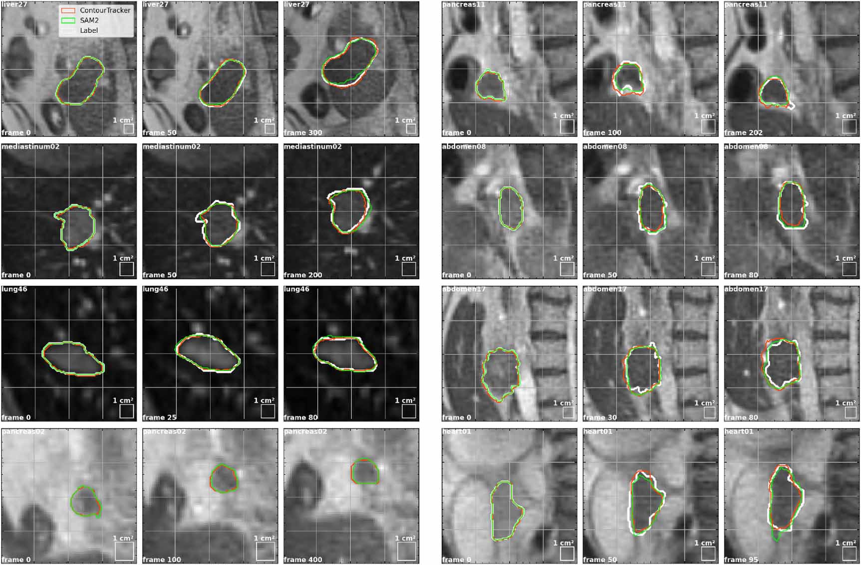 MRgRT real-time target localization using foundation models for contour ...