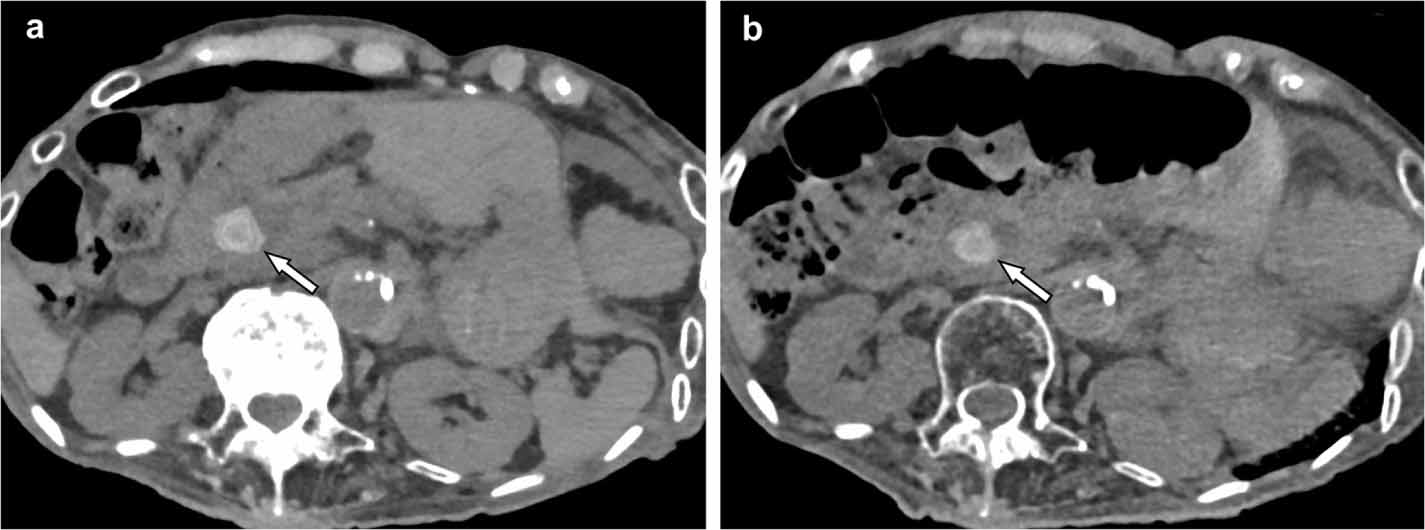 Photon-counting CT in cancer radiotherapy: technological advances and ...