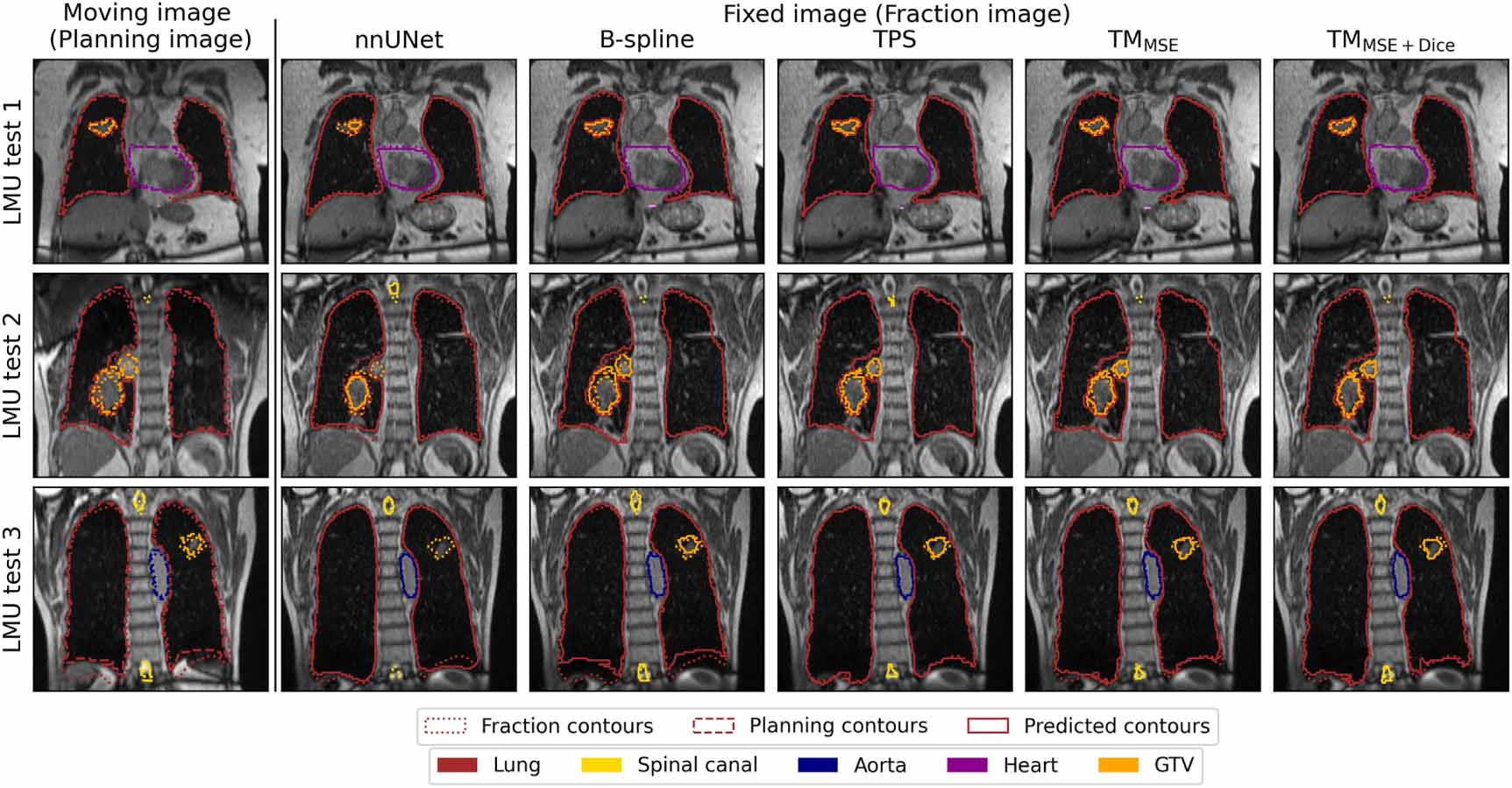 Deep learning-based contour propagation in magnetic resonance imaging ...