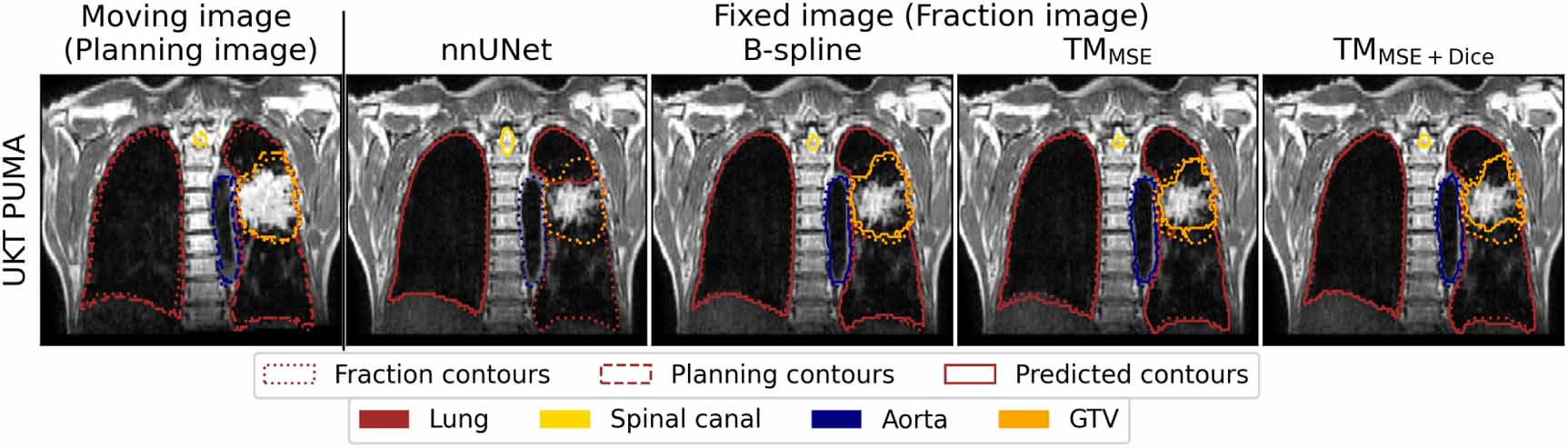Deep learning-based contour propagation in magnetic resonance imaging ...